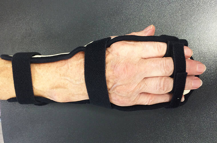 Orthèse de main sur mesure - reha team - ortho team