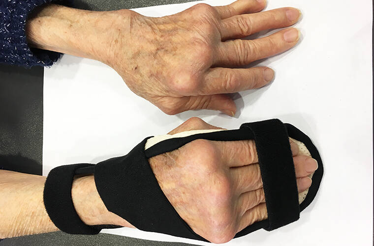 Orthèse de main sur mesure - reha team - ortho team